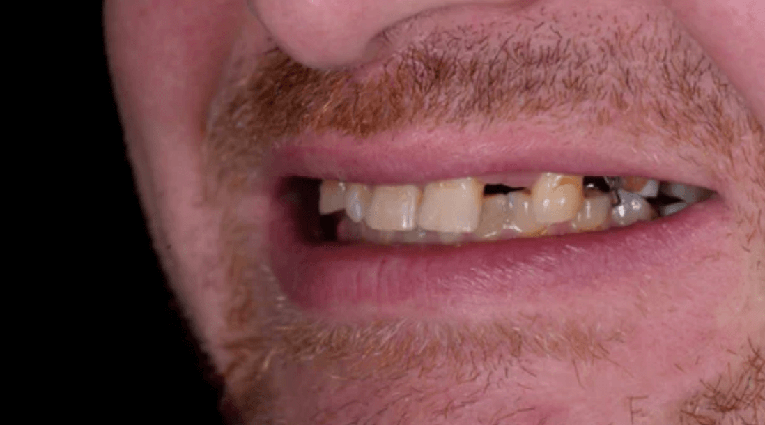 5 Signs You Need Dental Implants: Don’t Overlook These Warning Signals ...