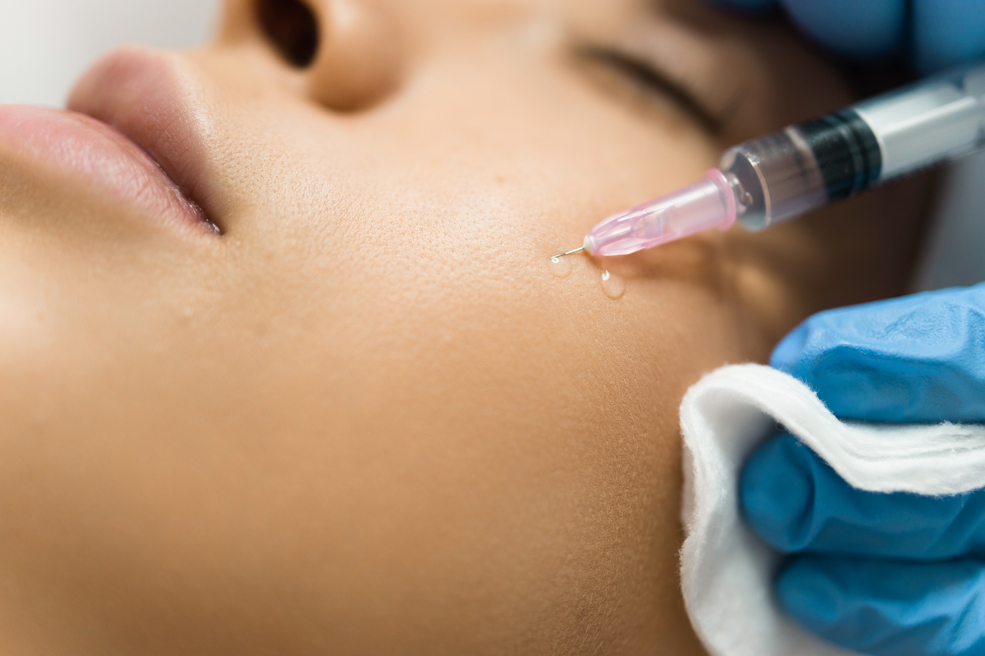 PRP vs. Traditional Filler: A Safer Option for Sensitive Areas in ...